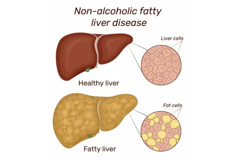 Non Alcoholic Fatty Liver Disease Solution NAFLD treatment plan ...